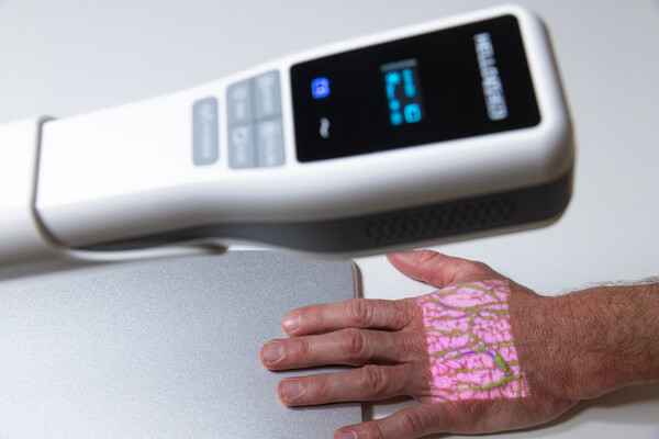 Hellovein ® | Clinical Gallery